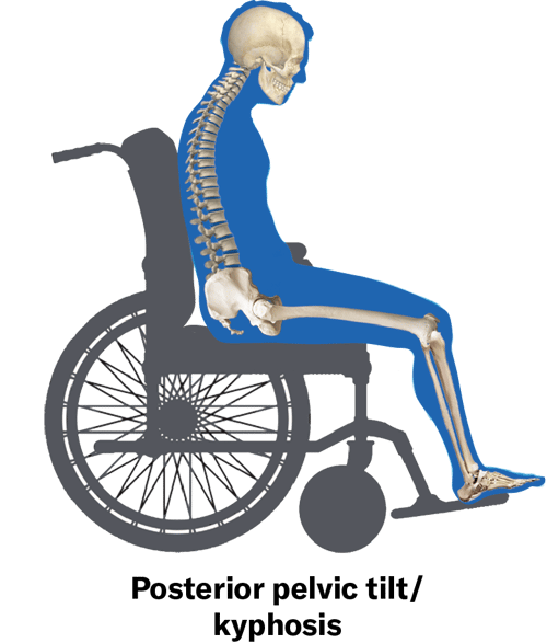 Sliding Into the Reality of Posterior Pelvic Tilt